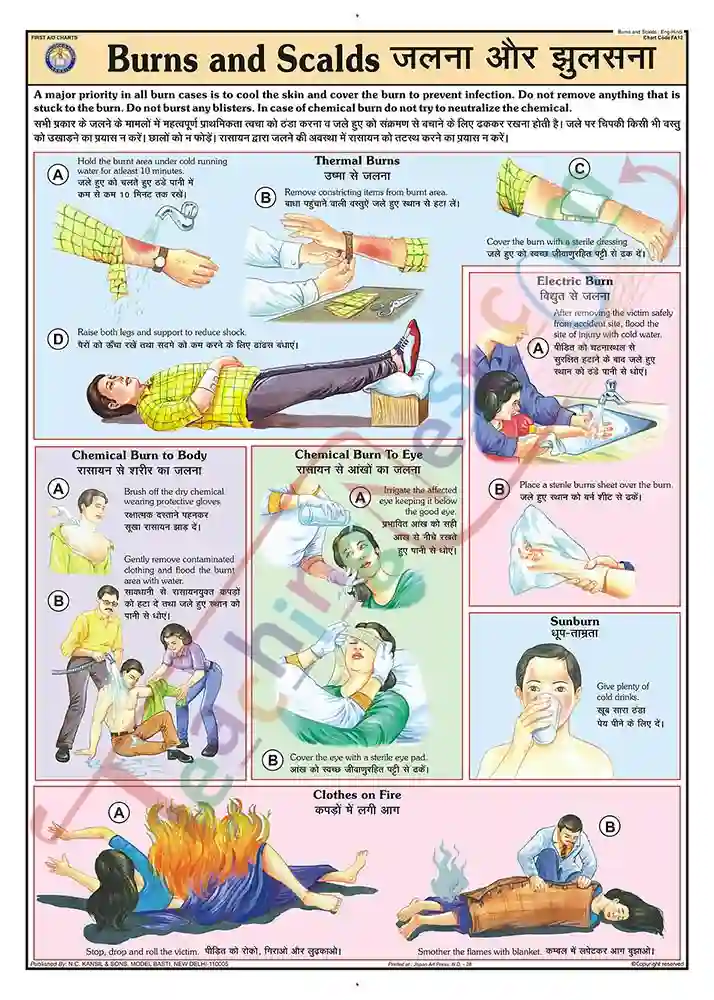 Burns & Scalds Chart - Laminated, With Rollers, 50×70 cm, English and ...
